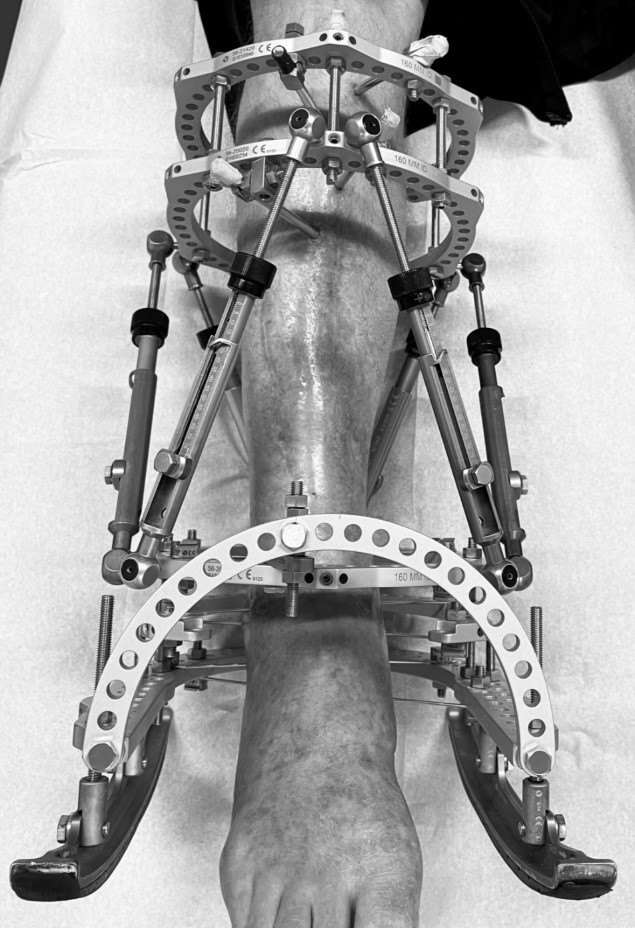 Niet genezende botbreuk - Aandoening - Erasmus MC